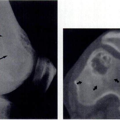 Osteosarcoma Simulating Osteoblastoma A Anteroposterlor Radiograph Download Scientific