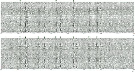 Figure 1 From Fully Automated Spike Detection And Dipole Analysis Of