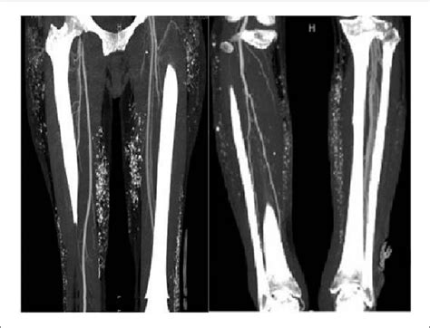 Initial Lower Extremity Cta Findings The Scans Show Multiple Download Scientific Diagram