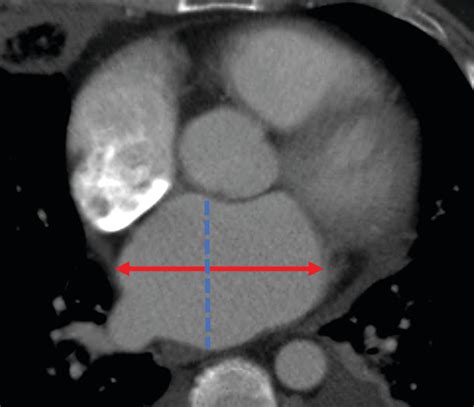Diagnostic Accuracy Of Sex Specific Chest Ct Measurements Compared With