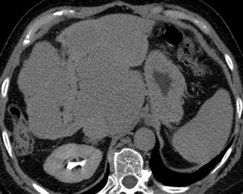 Cholangitis Ct