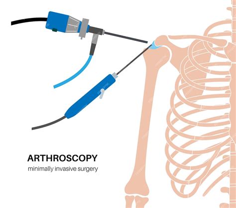 Premium Vector Shoulder Arthroscopy Procedure Rotator Cuff Tears Or Shoulder Joint Replacement