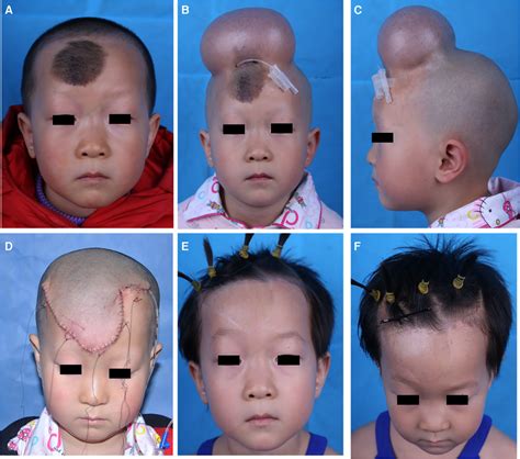 Case 1 A A 4 Year Old Girl With Congenital Nevus 5 × 4 Cm² On Download Scientific Diagram