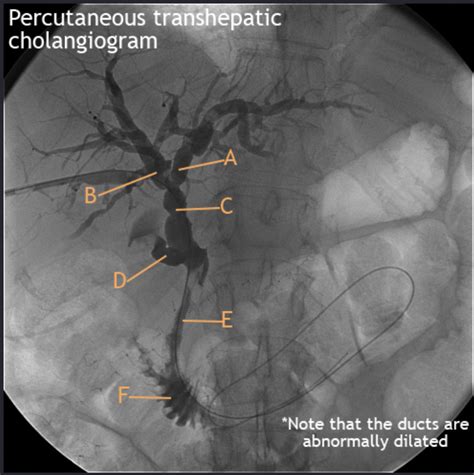 Percutaneous Transhepatic Cholangiogram Diagram Quizlet