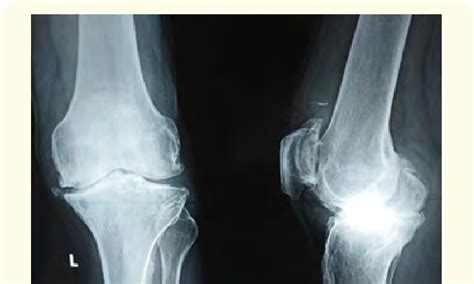 Osteoarthritis Is A Degenerative Joint Disease The