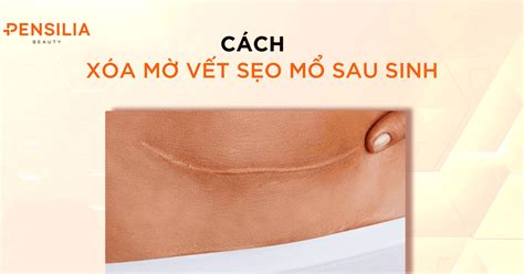 Xóa Mờ Vết Sẹo Mổ Sau Sinh Pensilia