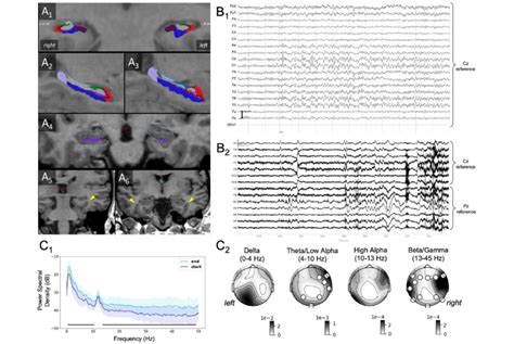 Structural Mri Showing A Partial Incomplete Hippocampal Inversion A1