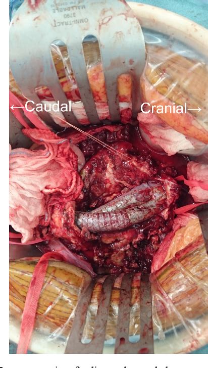 Figure 3 From A Surgical Case For Abdominal Aortic Aneurysm With