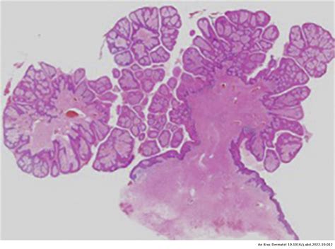 Case For Diagnosis Multiple Nodules On The Scrotum Verruciform