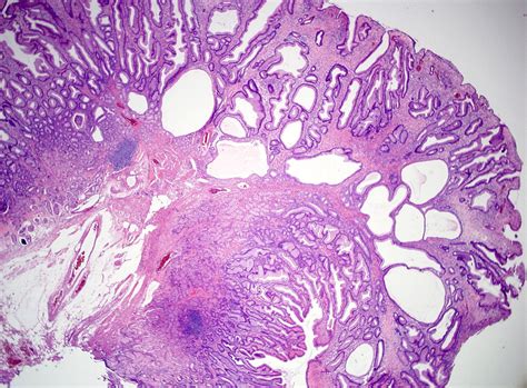 Hyperplastic Polyp