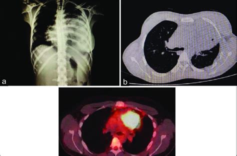 A Chest X Ray B Contrast Enhanced Computed Tomography Chest C Download Scientific