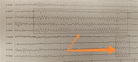 Normal EEG Waveforms Images Flashcards Quizlet