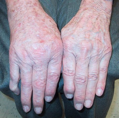 Review Of Calcium Pyrophosphate Deposition Disease Rheumnow