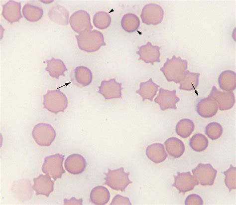 Pyknocyte Archives Eclinpath