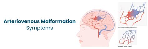 Arteriovenous Malformations Symptoms Diagnosis And Treatment