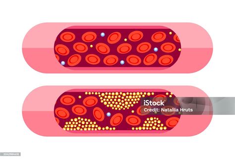 콜레스테롤의 종류 Hdl 및 Ldl 콜레스테롤 유형 교육 정상 및 좁아진 동맥으로 분류됩니다 벡터 일러스트 레이 션 트리글리세리드에 대한 스톡 벡터 아트 및 기타 이미지