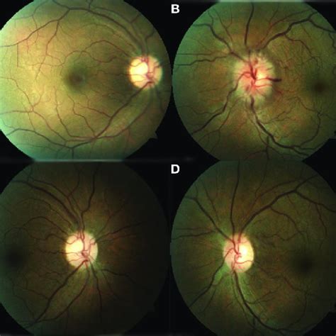 Correlation Between The Ganglion Cell Layer Gcl Retinal Nerve