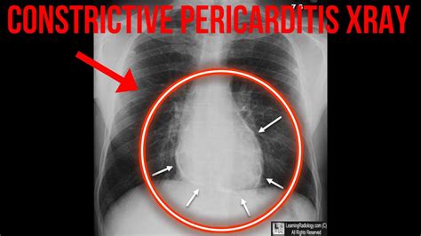 Constrictive Pericarditis Xray Findings All Differentials Youtube