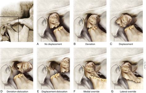 Mandibular Condyle Fractures Pocket Dentistry