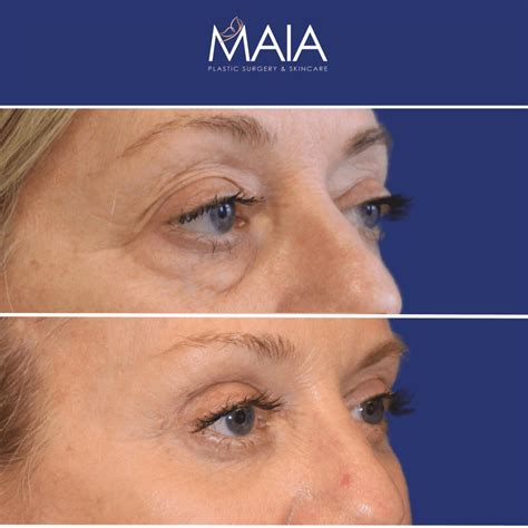 Upper Blepharoplasty Before After