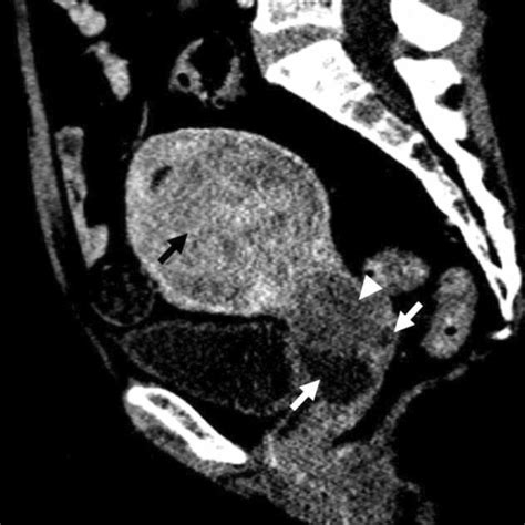 Tvus Images Demonstrate An Incidental Tunnel Cluster Of Simple Cysts