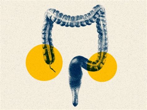 Clostridioides Difficile C Diff Colitis University Of Michigan Health