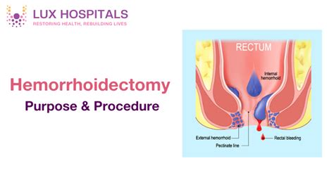 Hemorrhoidectomy Purpose Procedure And Recovery Tips