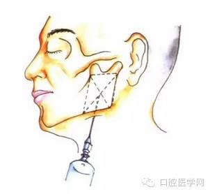 桡骨乙状切迹 尺骨乙状切迹 乙状切迹 第14页 大山谷图库