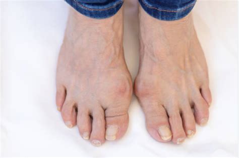 엄지발가락 통증 일으키는 질환 네이버 포스트