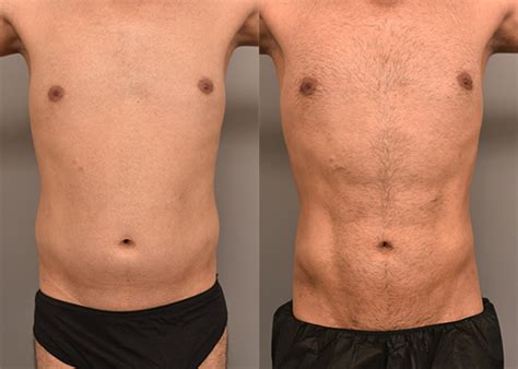 Lipo 360 With Liposculpture In Men Case 240