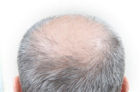 Early Balding Crown