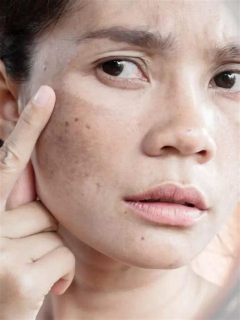 முகப்பரு பிரச்சனைக்கு உடனடி தீர்வு இந்த இலை போதும் Tamilsamayam