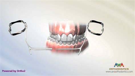 Different Types Of Orthodontic Expanders At Tenisha Broadnax Blog