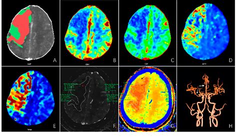 Figure 1 From Nomogram Based On Dual Layer Spectral Detector Cta Parameter For The Prediction Of