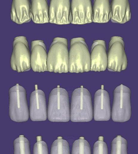 3d File Exocad Librerias Cutback 🦷 ・3d Printable Model To Download・cults
