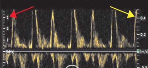 Chapter 2 Doppler Principles Flashcards Quizlet