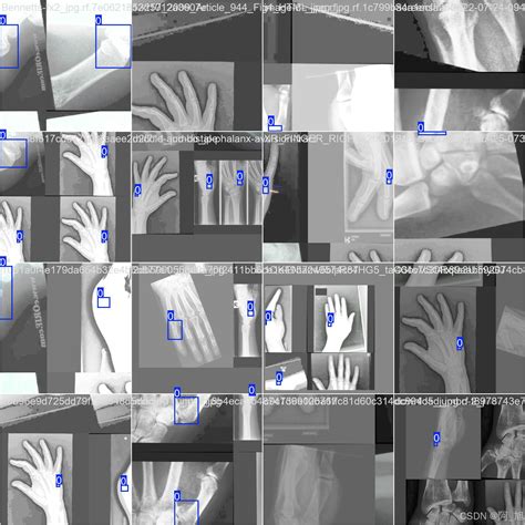 基于yolo11深度学习的医学x光骨折检测与语音提示系统【python源码pyqt5界面数据集训练代码】 Csdn博客