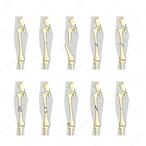 Bone Fractureleg Anatomy Bones Stock Vector