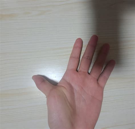 엄지손가락이 과신전되어서 질문드립니다 ㅣ 궁금할 땐 아하