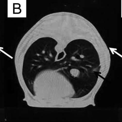 Pdf Consecutive Ct Guided Core Needle Tissue Biopsy Of Lung Lesions