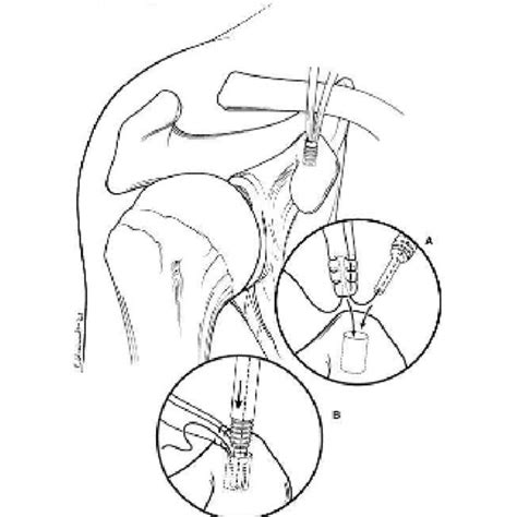 The Anatomical Coracoclavicular Reconstruction Showing Position Of The Download Scientific