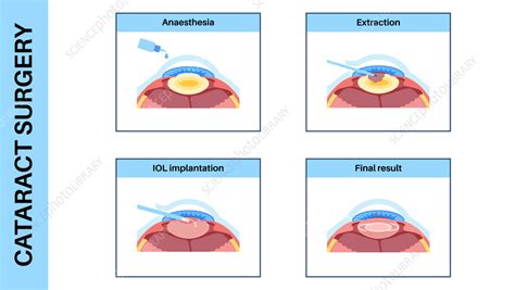 Extracapsular Cataract Extraction Illustration