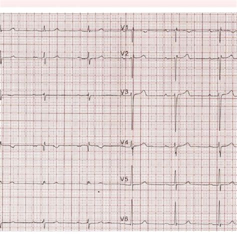 Partial Interatrial Block Download Scientific Diagram