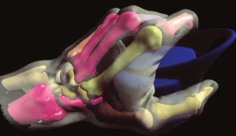 Surface Three Dimensional Rendering From Ct Depicted Here As A