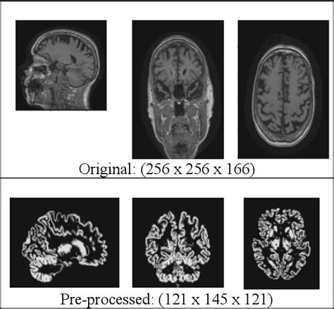 Figure 1 From Feature Extraction Of Alzheimers Disease Classification Based On Principal