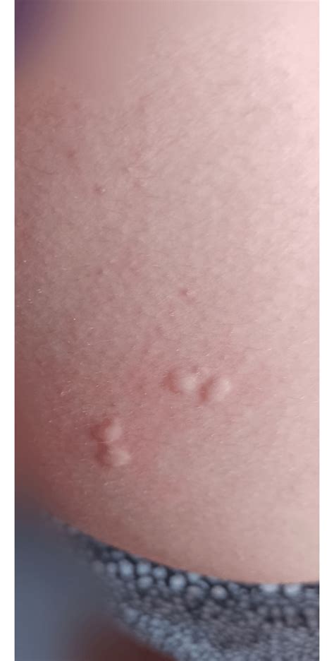 Help Me Identify This Bug Bite Please R Entomology