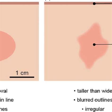 Color Online Comparison Between Benign A And Malignant B Tumors
