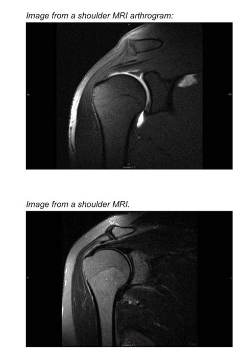 What Is An Mr Arthrogram An Midwest Imaging Centers