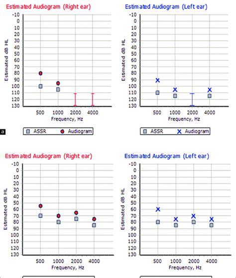 A Auditory Steady State Response Findings Case A B Auditory Download Scientific Diagram