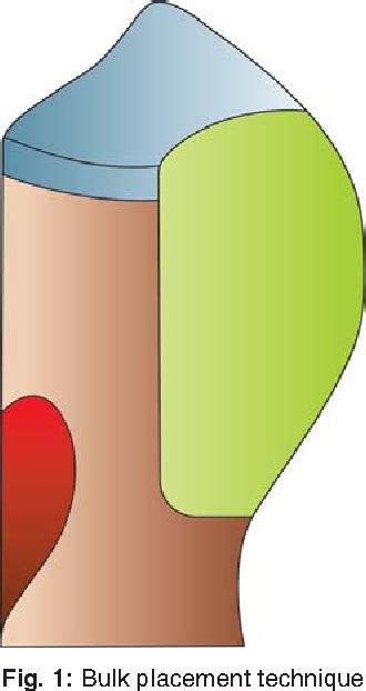 Figure 1 From Effect Of Four Different Placement Techniques On Marginal Microleakage In Class Ii